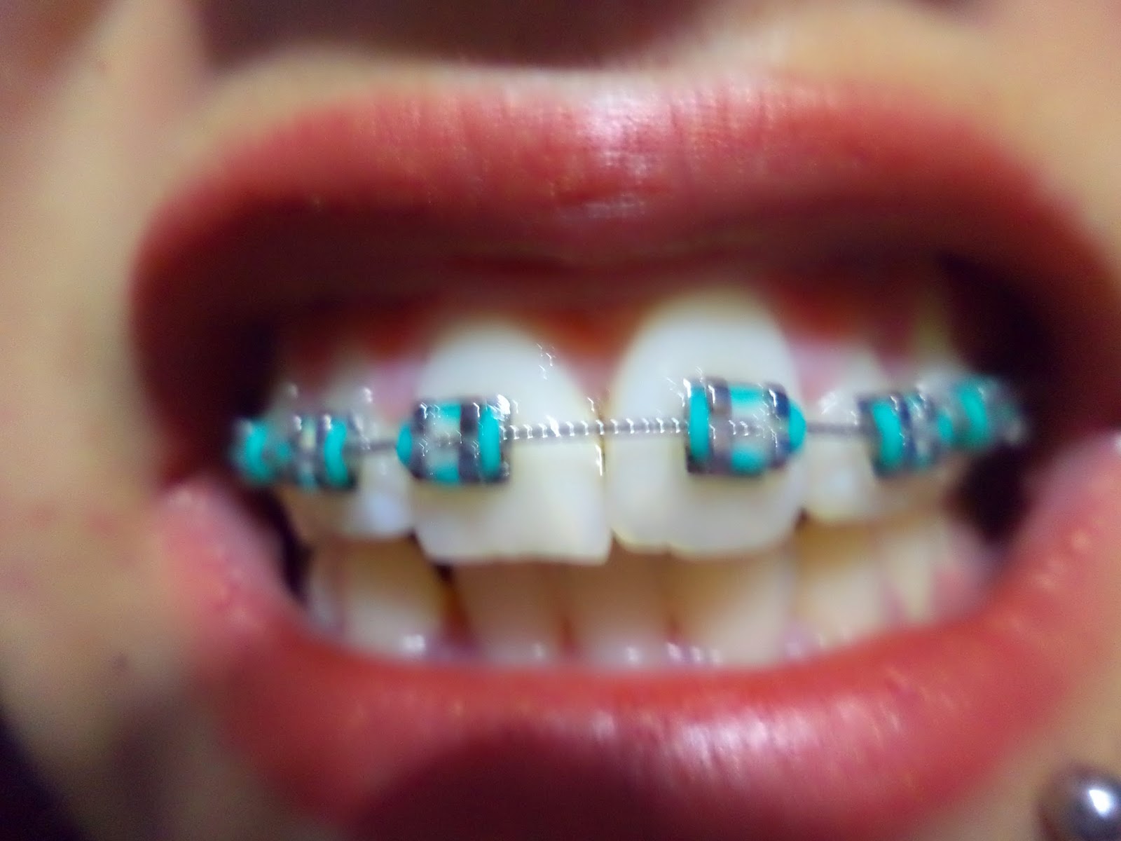 Mis Brackets: Paso a Paso [Mi experiencia]: 06/MAYO/2014 - CAMBIO DE LIGAS