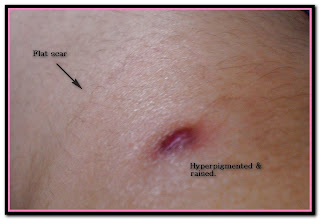 Lava Bean: Help! Scars and Boils and Rosehip oil.