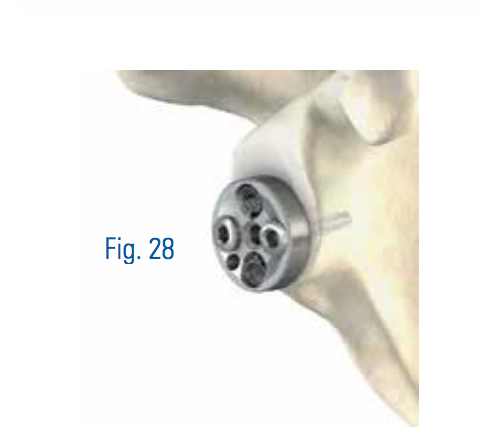 Shoulder and Elbow Surgery: The ideal position of the glenosphere in ...