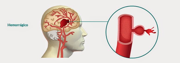 Enfermedad Vascular Cerebral Tipos De Enfermedad Vascular Cerebral