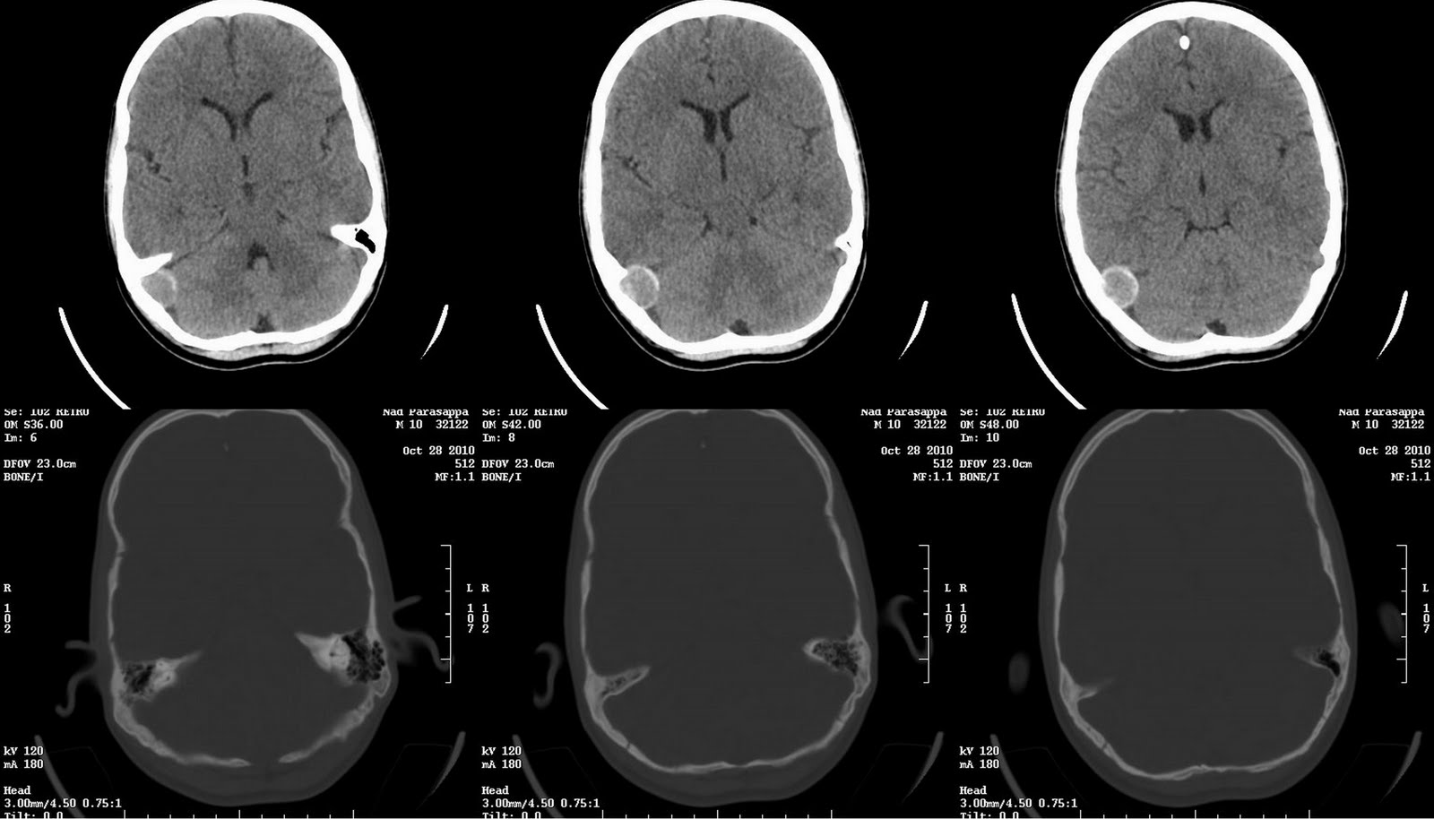 Dr Balaji Anvekar FRCR: Unusual sigmoid sinus lesion