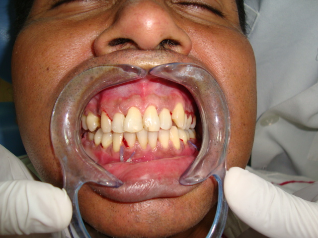 Dr. Alex Polit Luna- Cirujano Oral y Maxilo Facial.: Fractura Mandibular