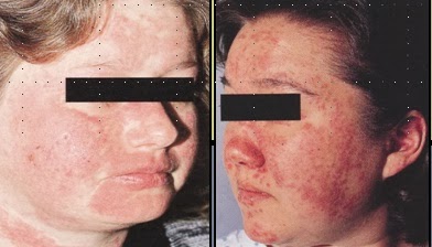 PUBLIC HEALTH: ACUTE COETANEOUS LUPUS ERYTHEMATOSUS