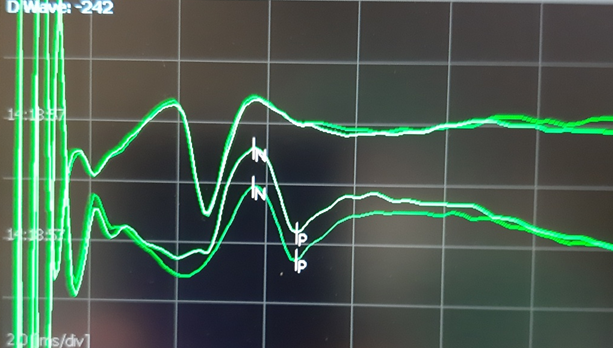 Neurophysiology Plus Iceland: D wave IONM in Iceland. Third case ...