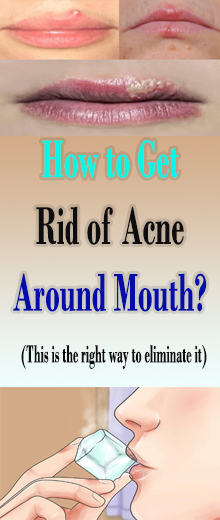 How To Get Rid Of Acne Around Mouth The News Pins how-to-get-rid-of-acne-around-mouth-the-news-pins
