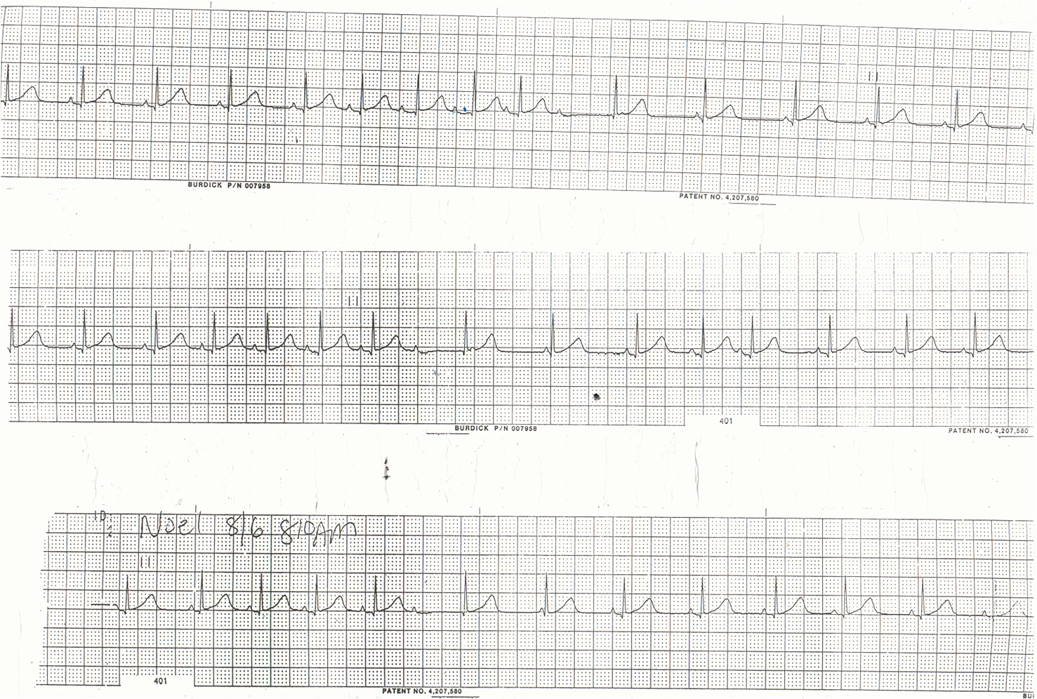 Pedi cardiology: EKG: Wenckebach phenomenon (during the fast HR phase ...