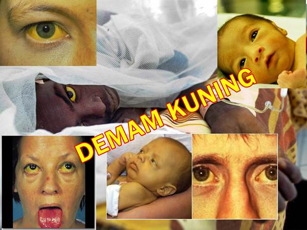 Pengobatan Demam Kuning Herbal - Jelly Gamat QnC Asli Original