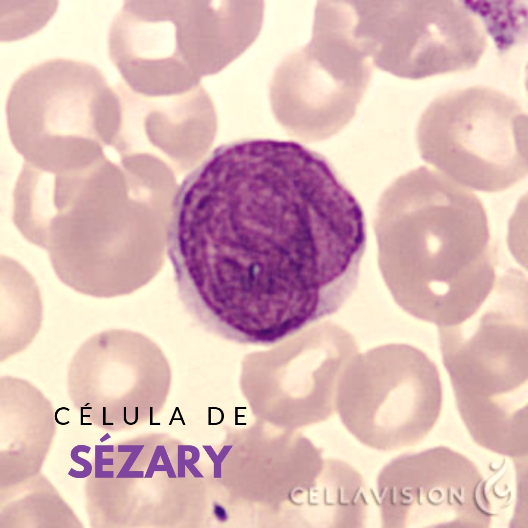 Grupo de Estudos Aplicados à Hematologia: Célula de Sézary