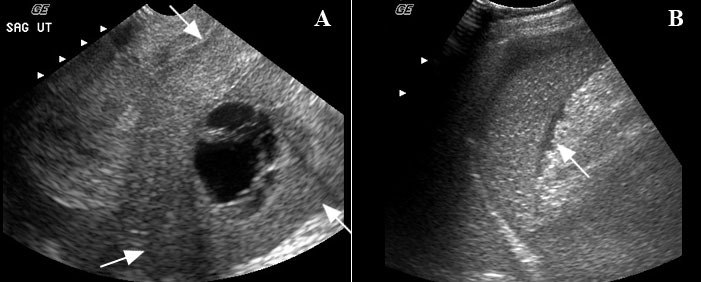Mga Kaalaman Tungkol Sa Ovary Cancer at Corpus Uteri