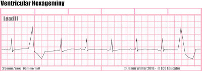 ECG Educator Blog : Six Second ECG Rhythm Strips