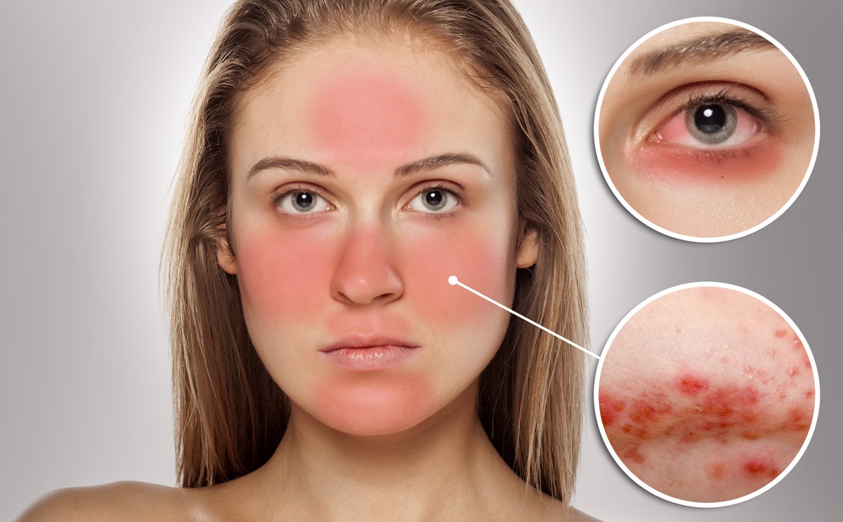 4 Simple Natural Remedies For Rosacea That Give Stunning Results ...