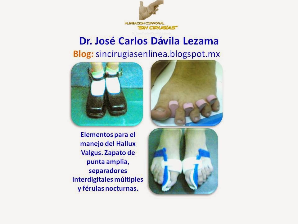 SIN CIRUGÍAS en LÍNEA: HALLUX VALGUS. Sugerencias, Parte II.