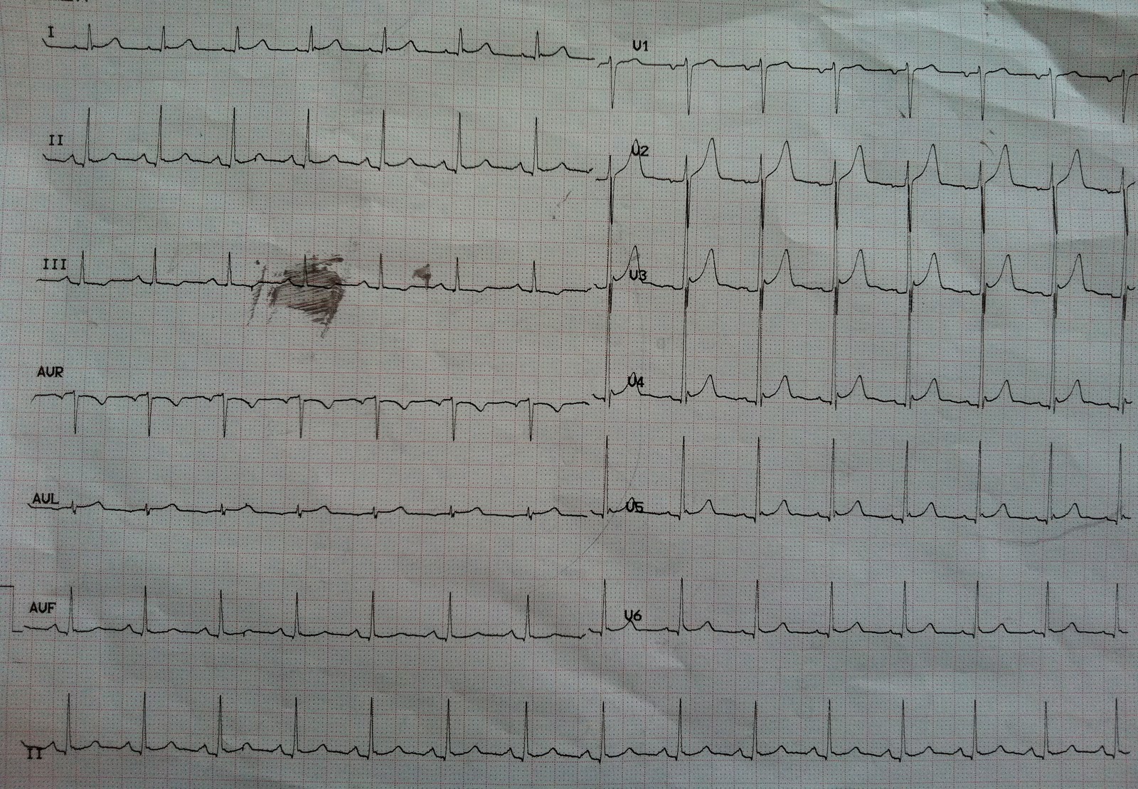 Dr Smiths Ecg Blog St Elevation Of Early Repolarization May Vary With The Rate