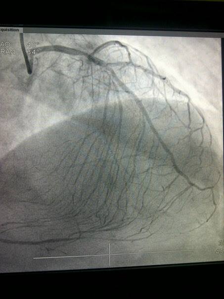 Extensive collaterals-Coronary Angiography - Sumer's Radiology Blog