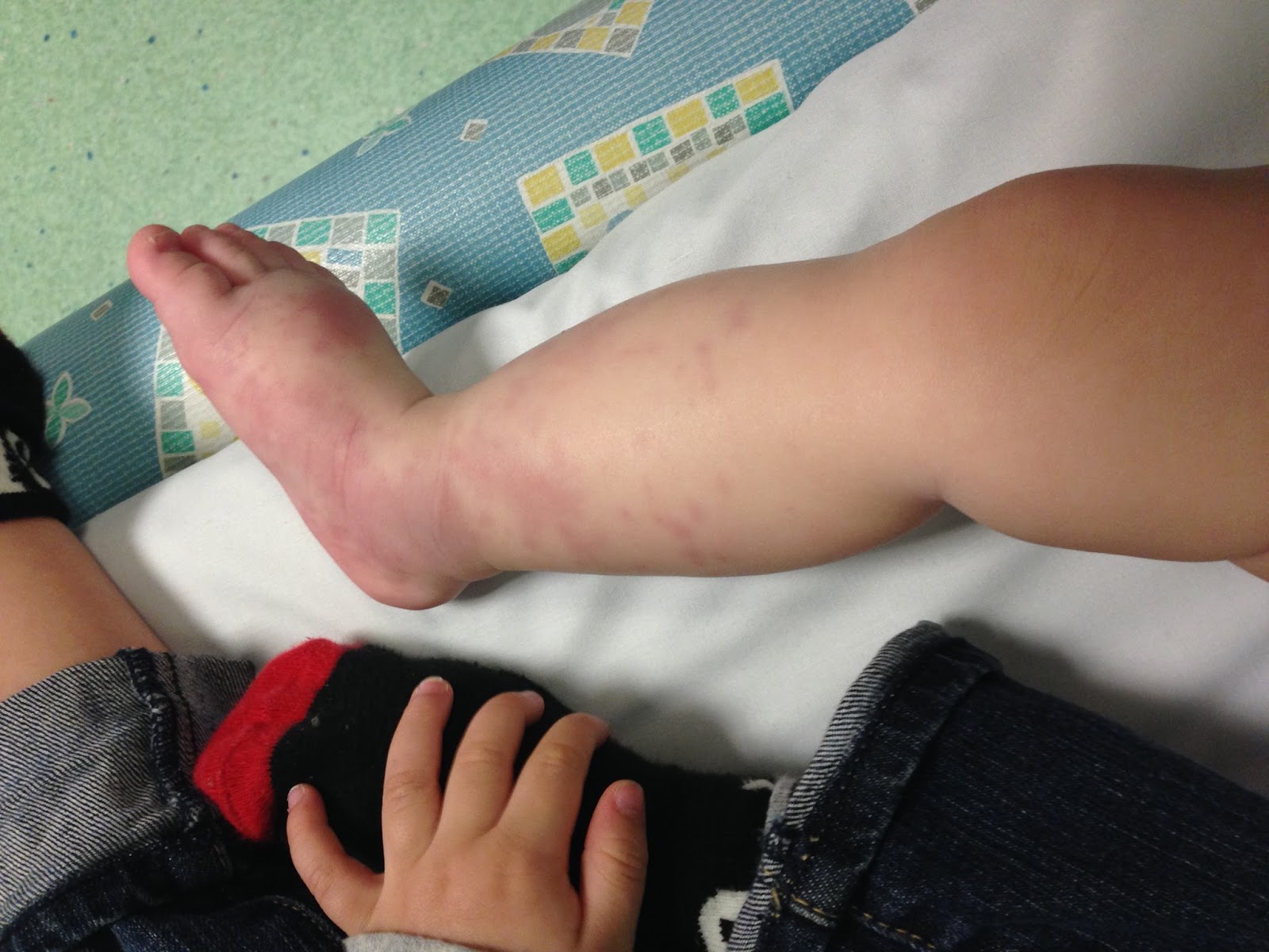 2 Littlefaces: When Sebby contracted HSP (Henoch-Schönlein Purpura)