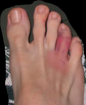 Treatment of Toe Injuries : Broken, Sprained, Fractured, Stubbed, or ...