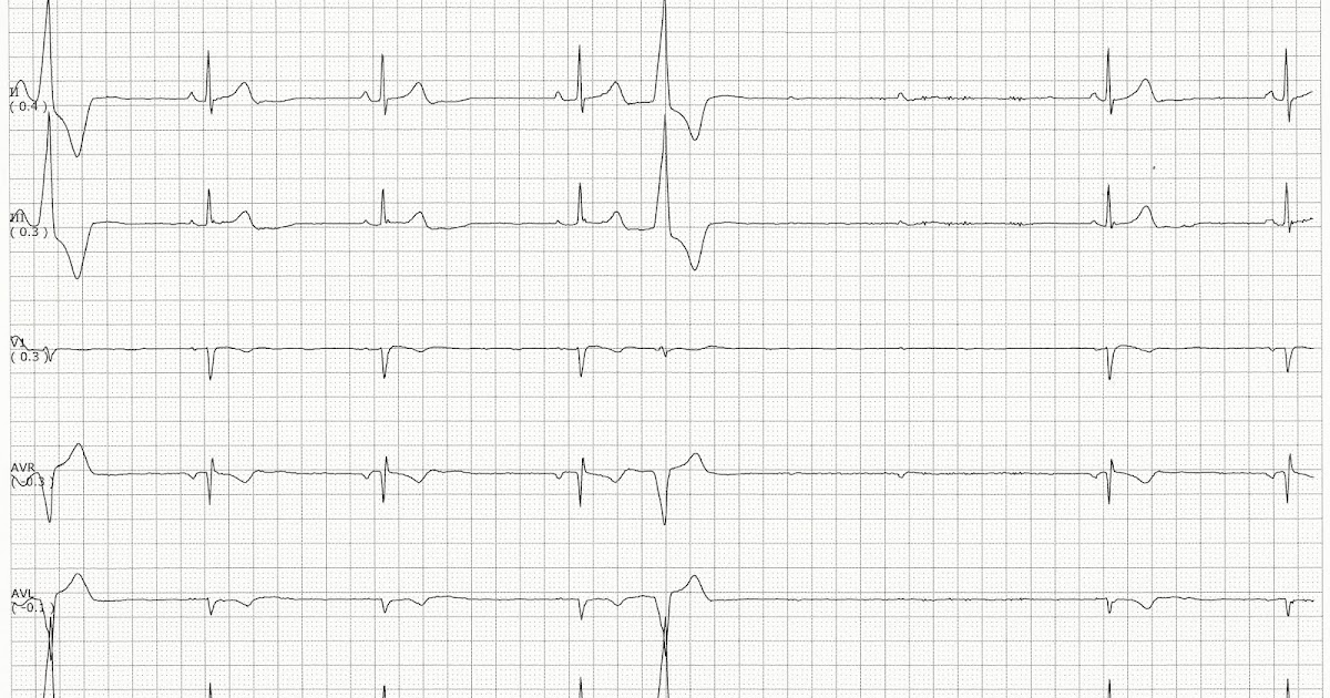 Float Nurse: Sinus bradycardia with unifocal PVCs and nonconducted P wave