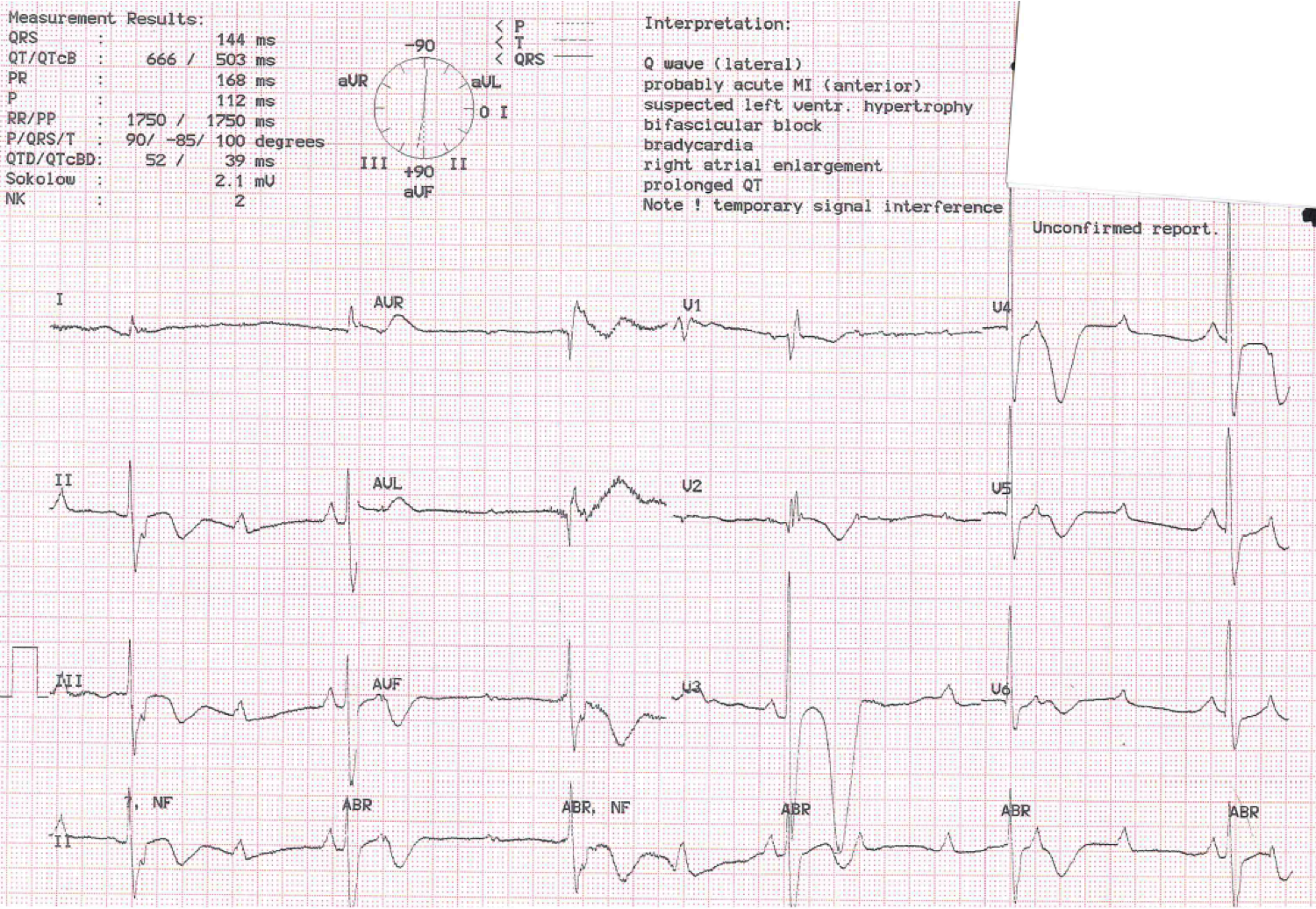 Dr. Smith's ECG Blog: Giant Inverted T waves in an Elderly Patient