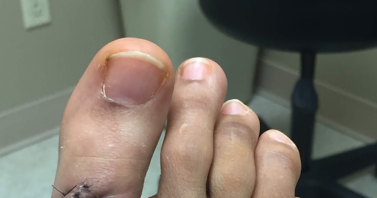 All About My 1st MPJ Foot Fusion: Week 2 (Part 2): Doctor's Office