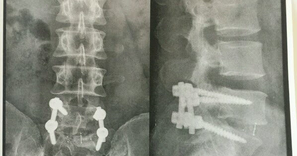 Artrodesis l5 s1 ( tlif ): Mi operación