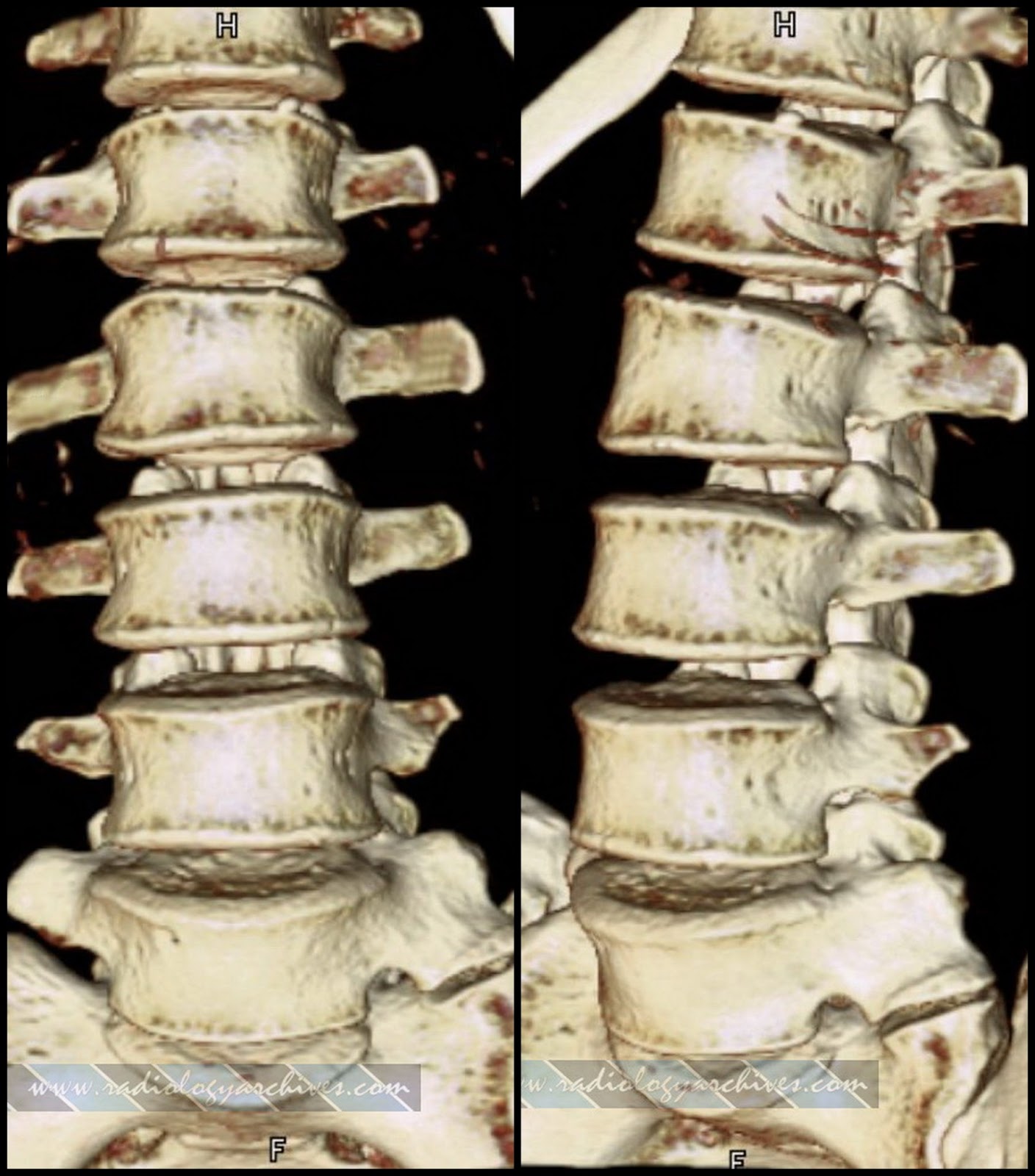 Radiology Archives: Μεταβατικός Oσφυοϊερός Σπόνδυλος - Οσφυοποίηση Ι1 ...