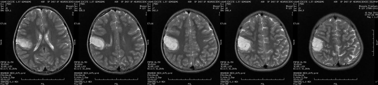 Dr Balaji Anvekar FRCR: Dysembryoplastic Neuro Epithelial Tumor (DNET)
