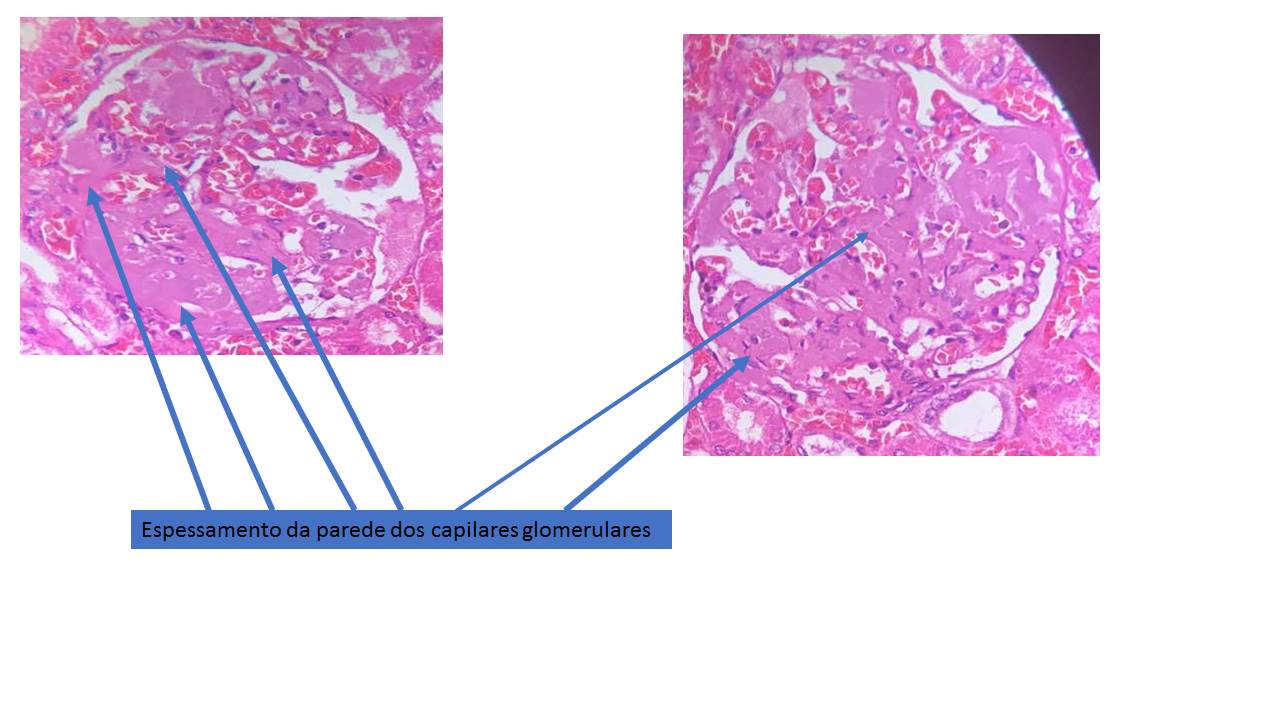 HISTOLOGIA90: RIM NORMAL E GLOMERULONEFRITES