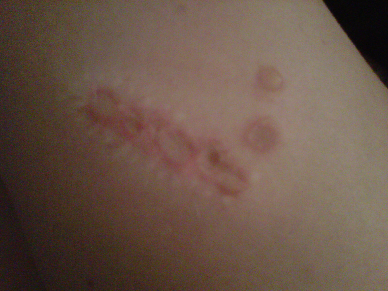 Self Injury Journey: Cigarette Burn on Flesh - Day 2