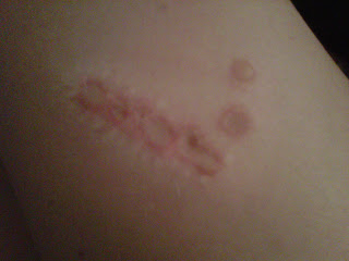 Self Injury Journey: Cigarette Burn on Flesh - Day 2