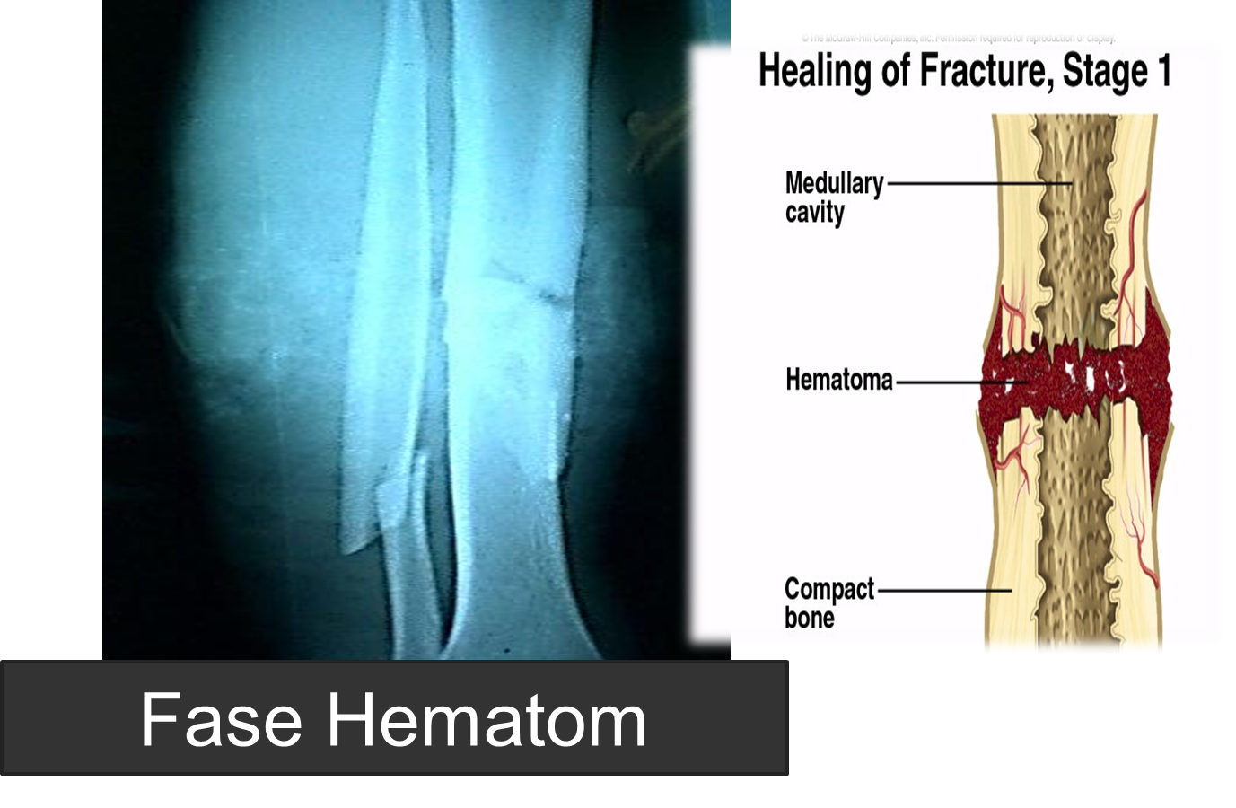 Creatio ex Nihillo: GAMBARAN RONTGEN PROSES PENYEMBUHAN FRAKTUR TULANG