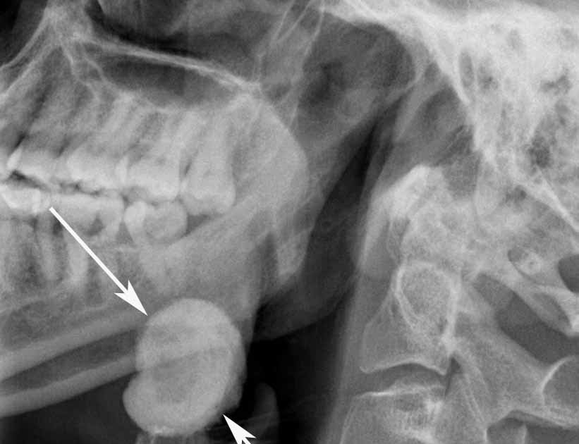 RiT radiology: Sialolithiasis