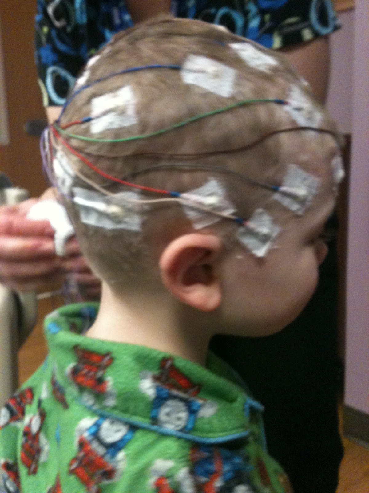 Joshua's Journey with Doose Syndrome: 48 Hour Video EEG in Hospital