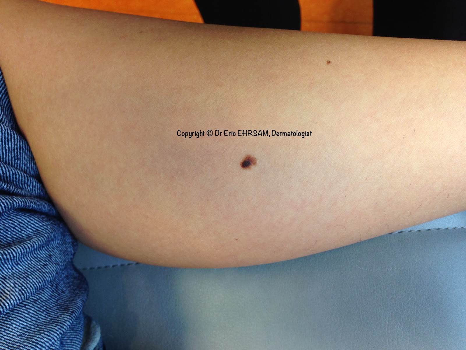 dermoscopy: Asymmetric pigmented lesion on a leg