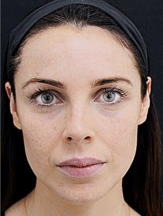 5 Reasons To Start Fillers in Your 30s - The Skin Radar