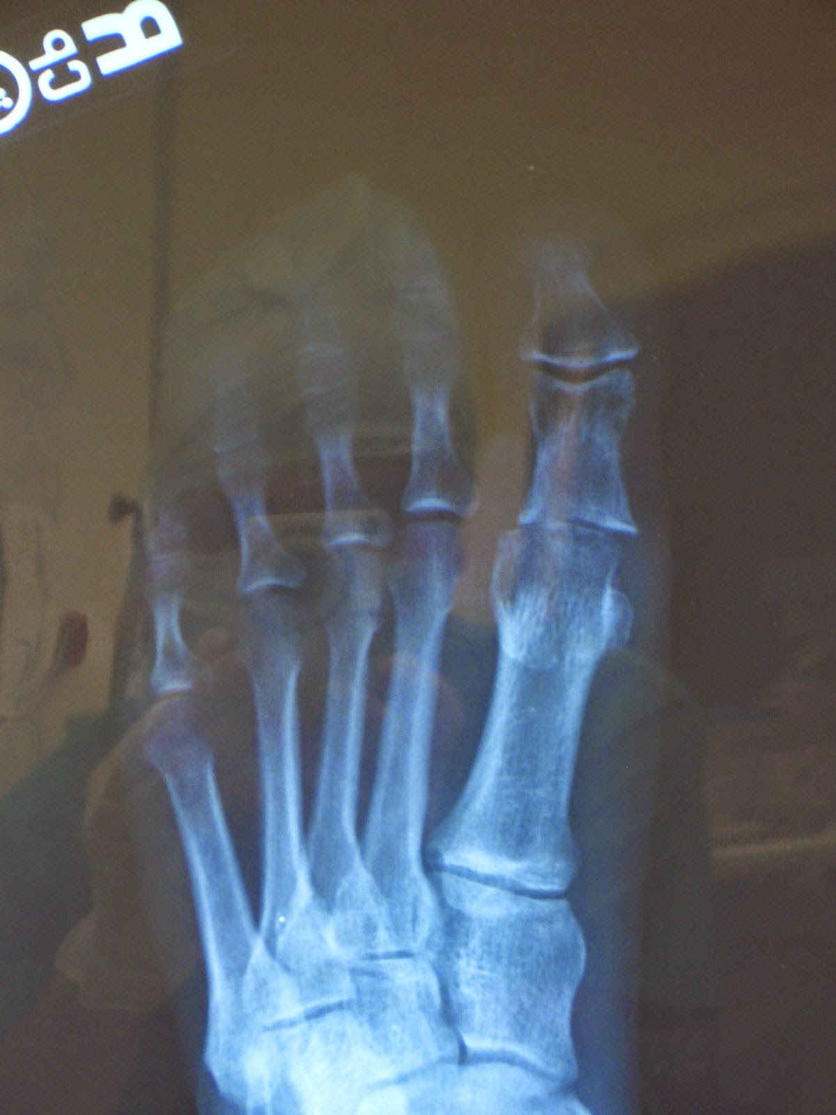 Podo Basas al Día: Operación de Hallux Límitus-Rígidus iatrogénico ...