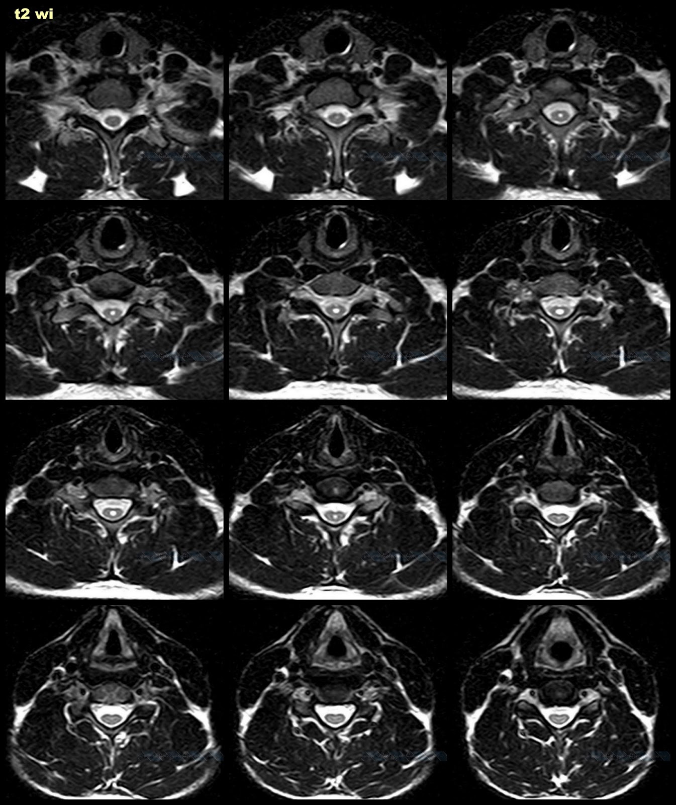 Radiology Archives: Υδρομυελία (Σύριγξ)
