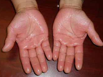 Introduction hyperhidrosis