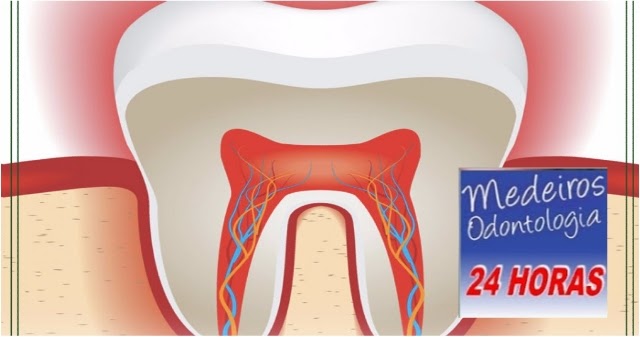 Medeiros Odontologia 24 Horas: O que é pulpite? Causas,Diagnóstico ...