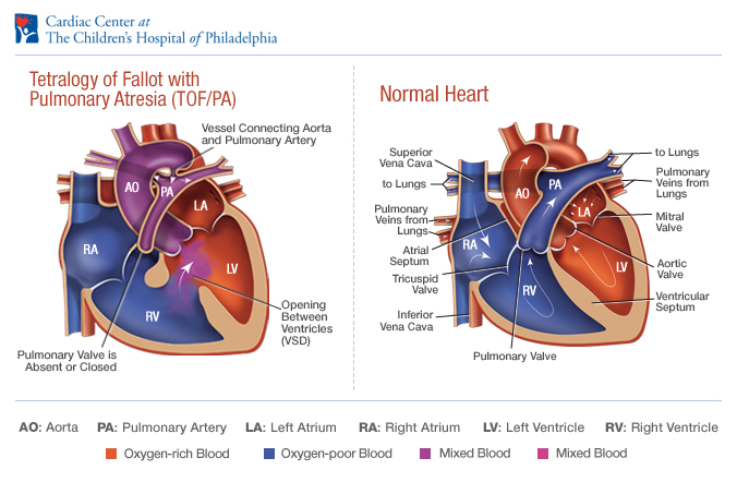 Little Johnson Heartbeat: Liam's Heart Journey