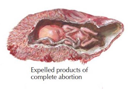 What is abortion and their types - WELFARE JAMBO
