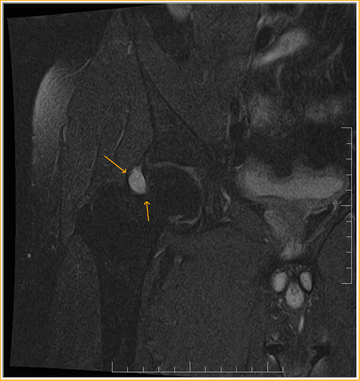 Acetabular Cyst with Femoro-acetabular impingement - Sumer's Radiology Blog
