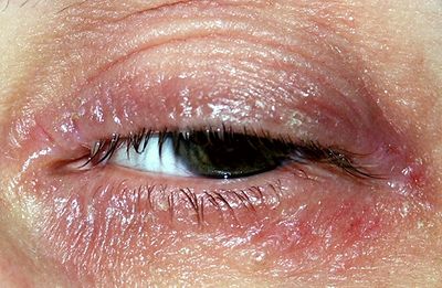 Eczema Around Eyes Treatment | Dyshidrotic Eczema Treatment