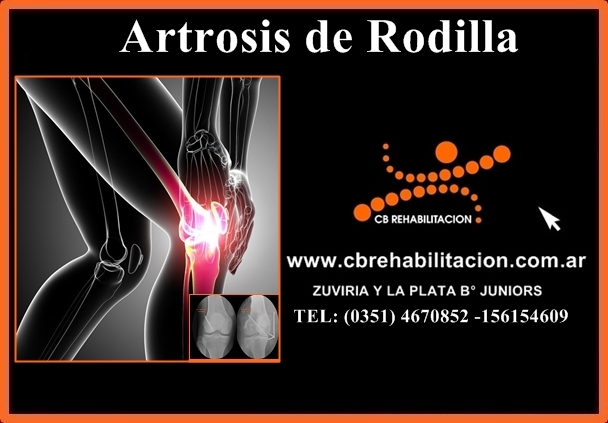 CARLE BARON REHABILITACION: ARTROSIS DE RODILLA