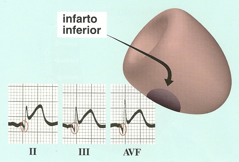 Electrocardiograma: Infarto agudo de miocardio de cara inferior