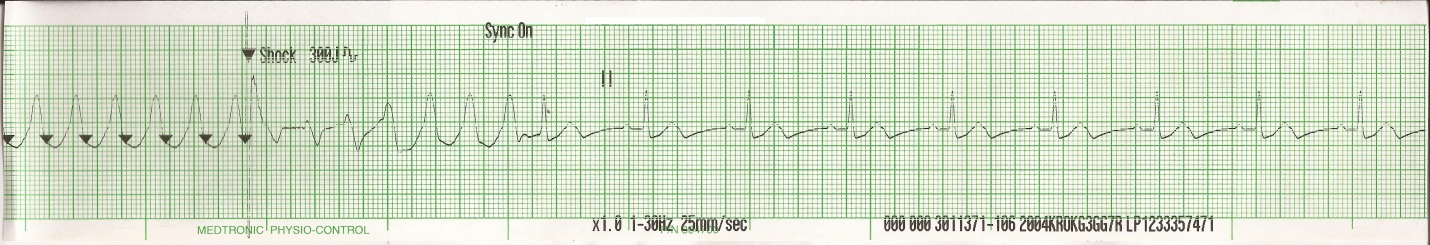 ECG Rhythm Strip Quiz 85: Electrical interventions
