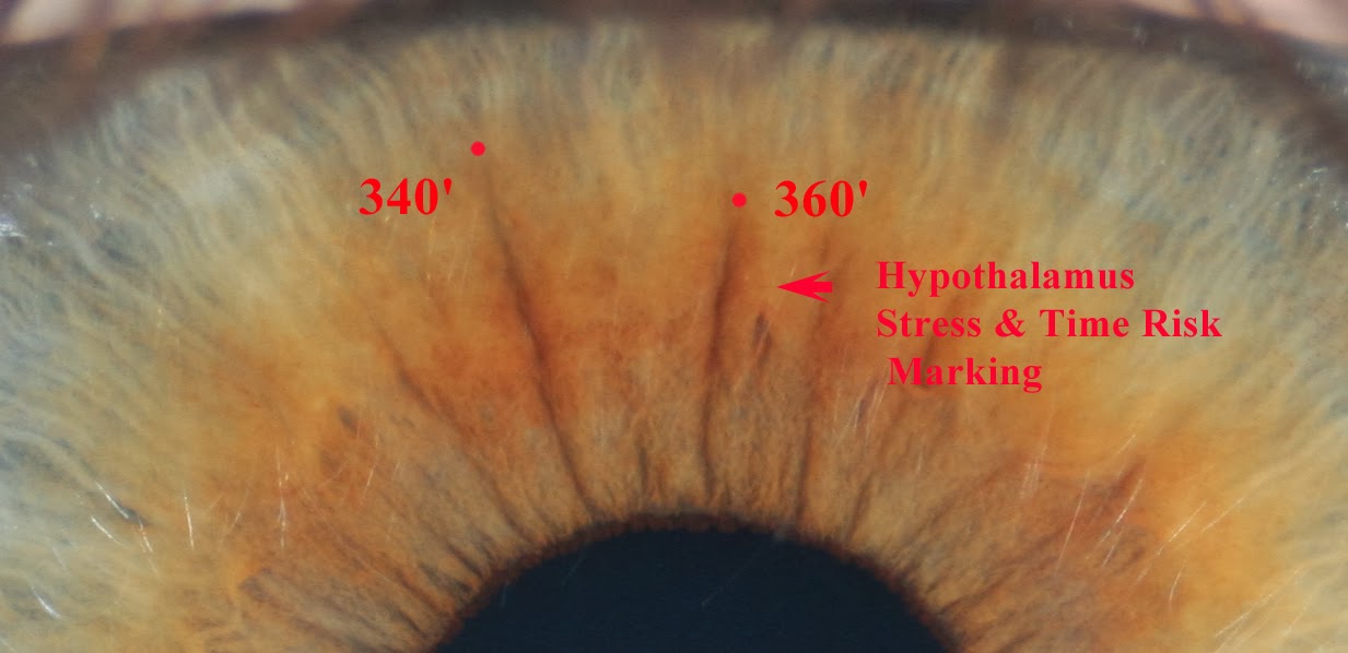 Modern & Multidimensional Iridology: Orange Central Heterochromia, Iris Signs at Pupillary ...