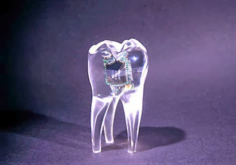 Clinica Dentis Implant: Microchip dental