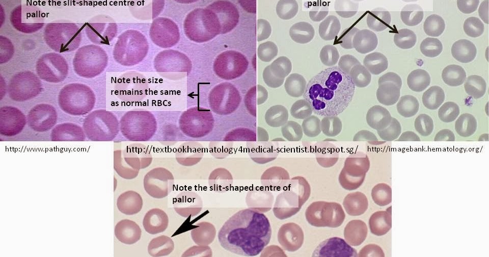 Haematology in a NutShell: Stomatocytes