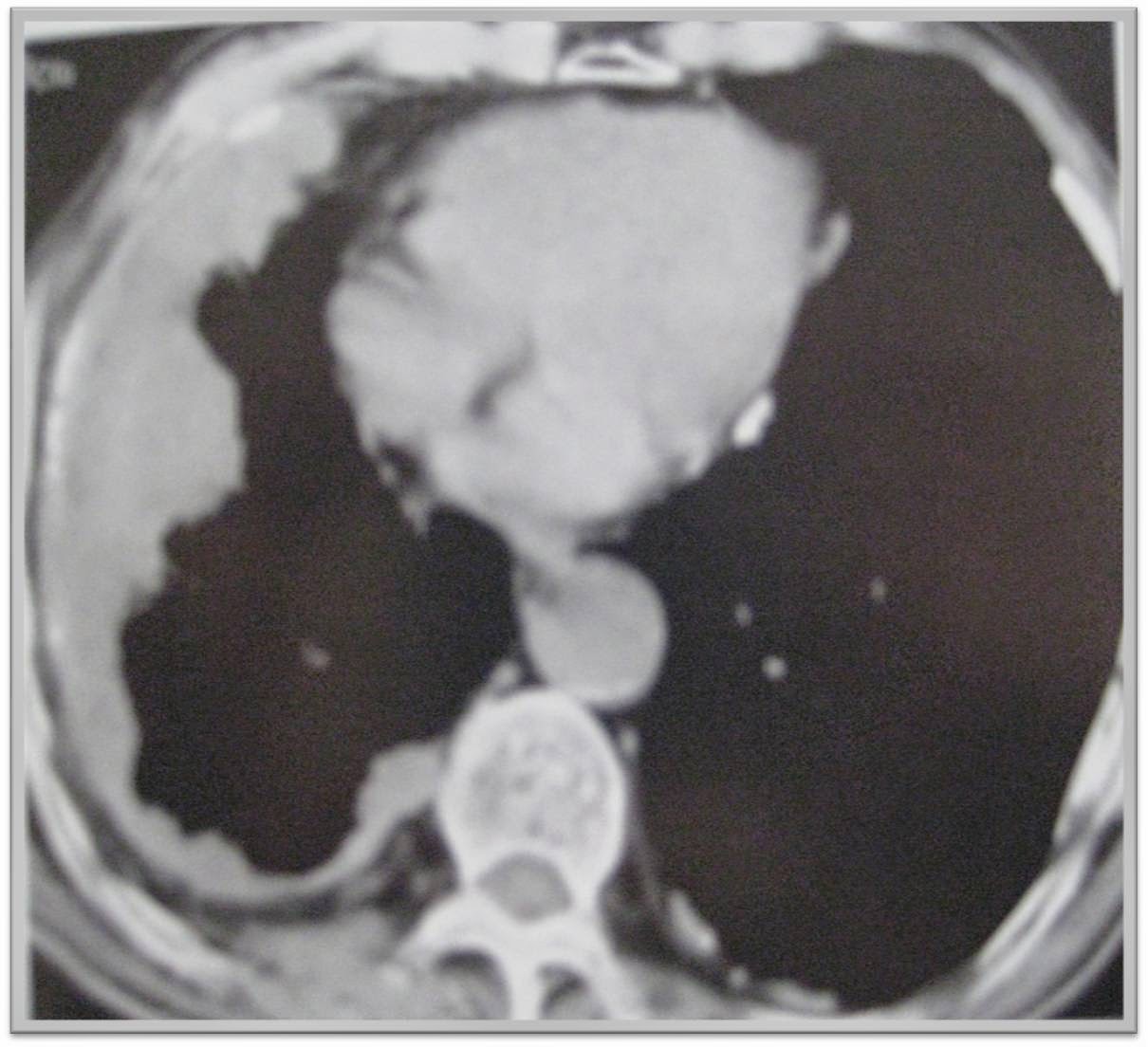 RADIOLOGY IMAGE SPOTTERS: Malignant mesothelioma