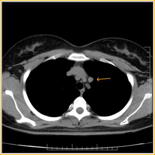 Partial Anomalous Left Upper Lobe Pulmonary Venous Drainage - Sumer's ...